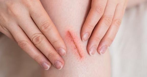 Marcas: quais são as fases do processo de cicatrização da pele - Saúde ...