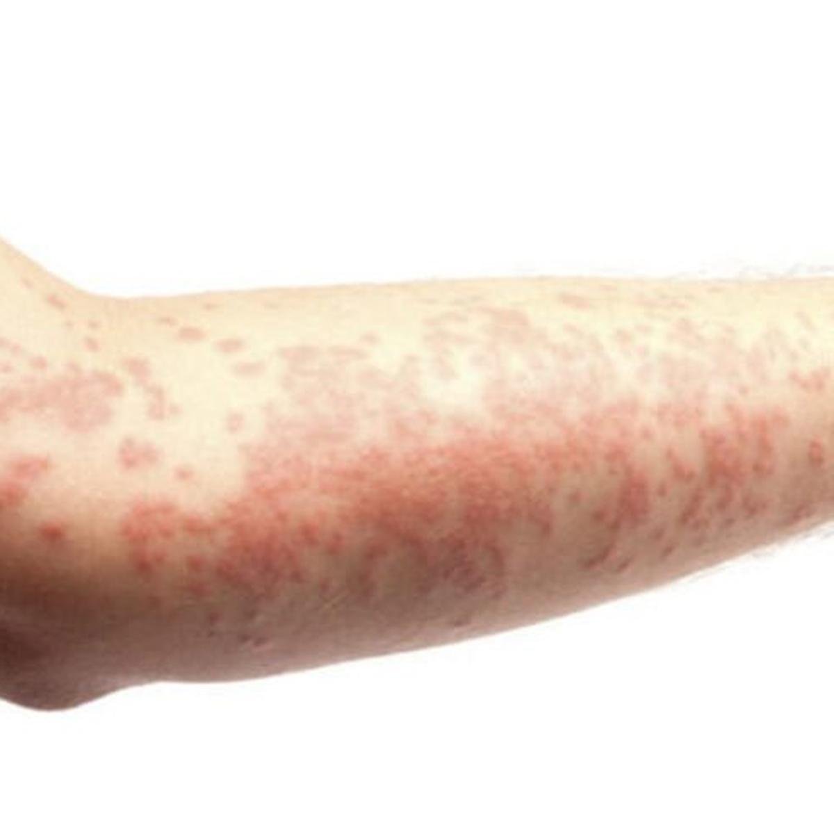Red Spots On Skin: 19 Causes & What They Look Like (with Pictures
