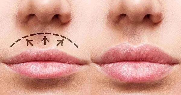 Quer volumizar, levantar e rejuvenescer os lábios de forma duradoura ...