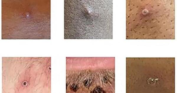 Homem contrai varíola dos macacos, HIV e COVID-19 ao mesmo tempo ...
