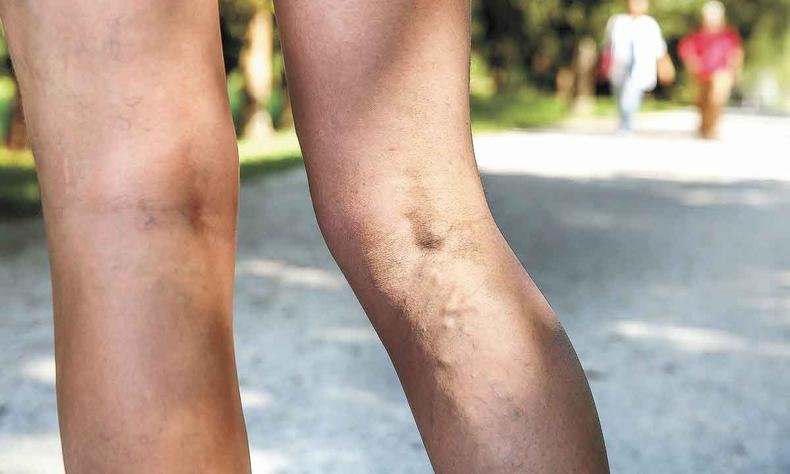 Varizes estragam perfeição de qualquer perna. Melhor é tratar - Anna ...